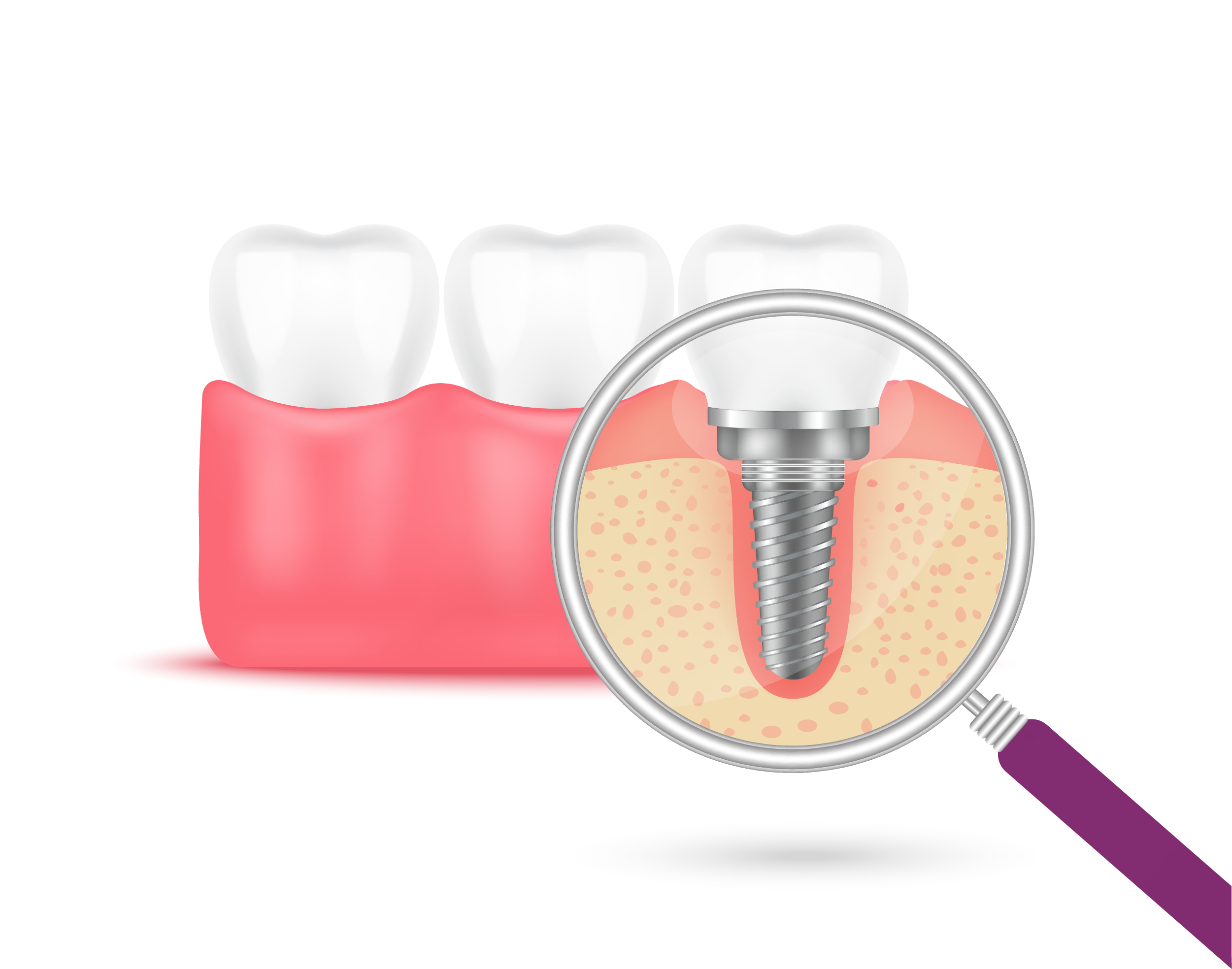 What is osseointegration in dental implants? - Osstell®