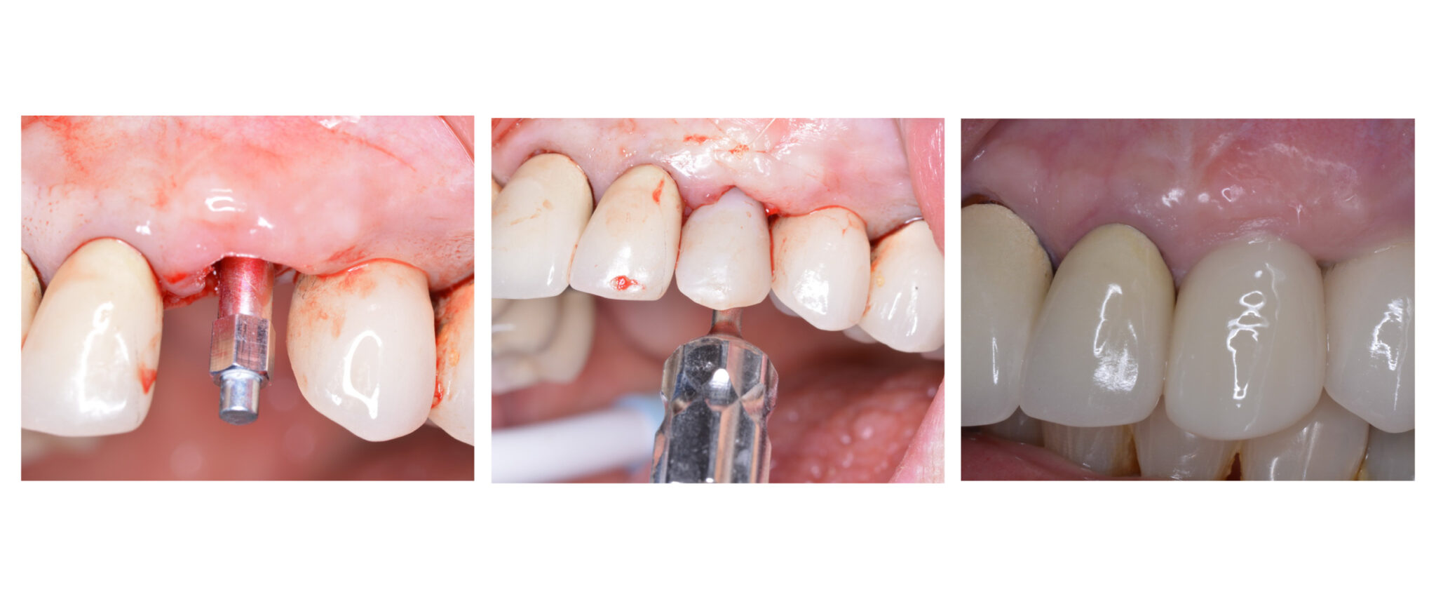 Osstell Blog – Implant Stability & Osseointegration - Osstell®