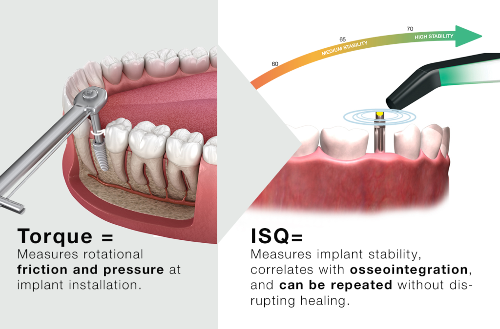 How ISQ correlates to torque - Osstell®