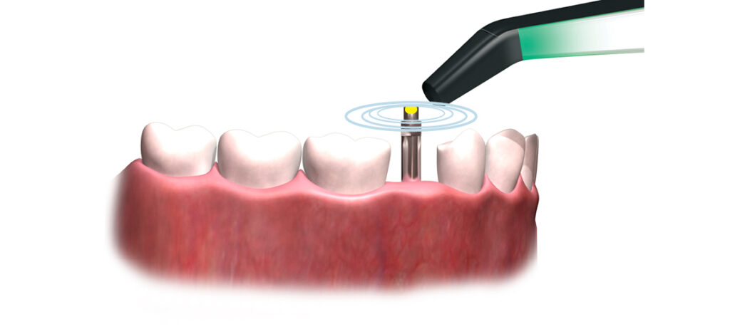 The technique behind Osstell - Osstell®