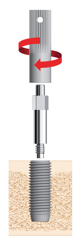 Verification & validation of implant alignment with confidence ...